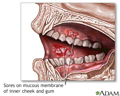 Mucous cyst Information | Mount Sinai - New York